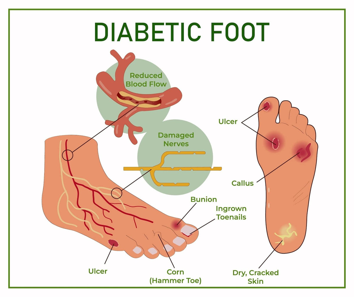 Diabetic Foot Ulcers | Viasox